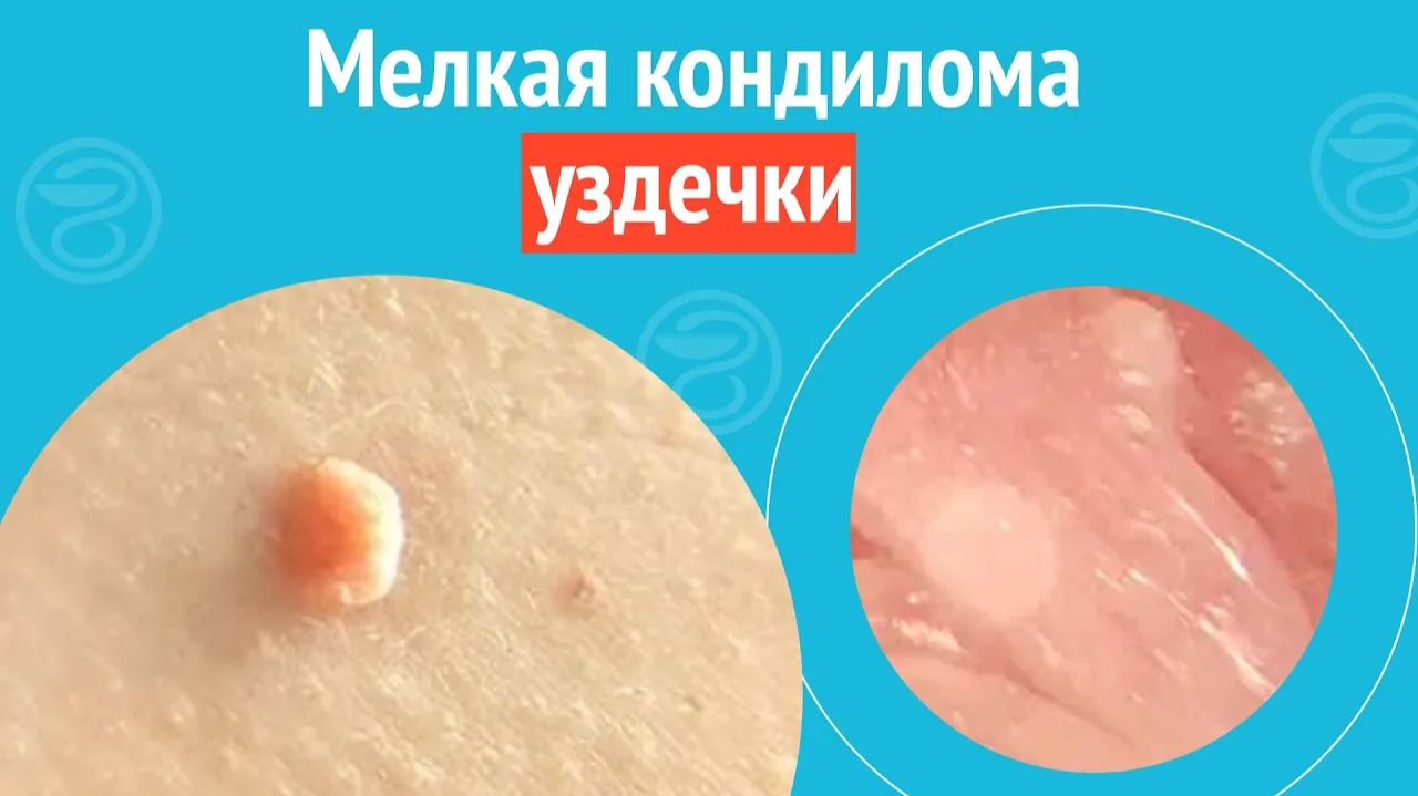 😐 Мелкая кондилома уздечки. Клинический случай №1307