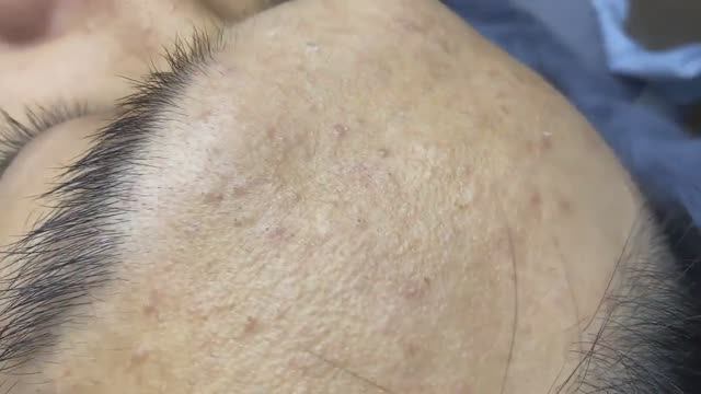 055 • Acne collection • АСМР • Relax Spa