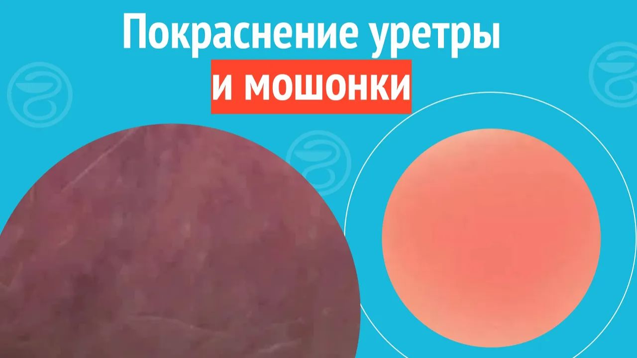 😱 Покраснение уретры и мошонки. Клинический случай №1324