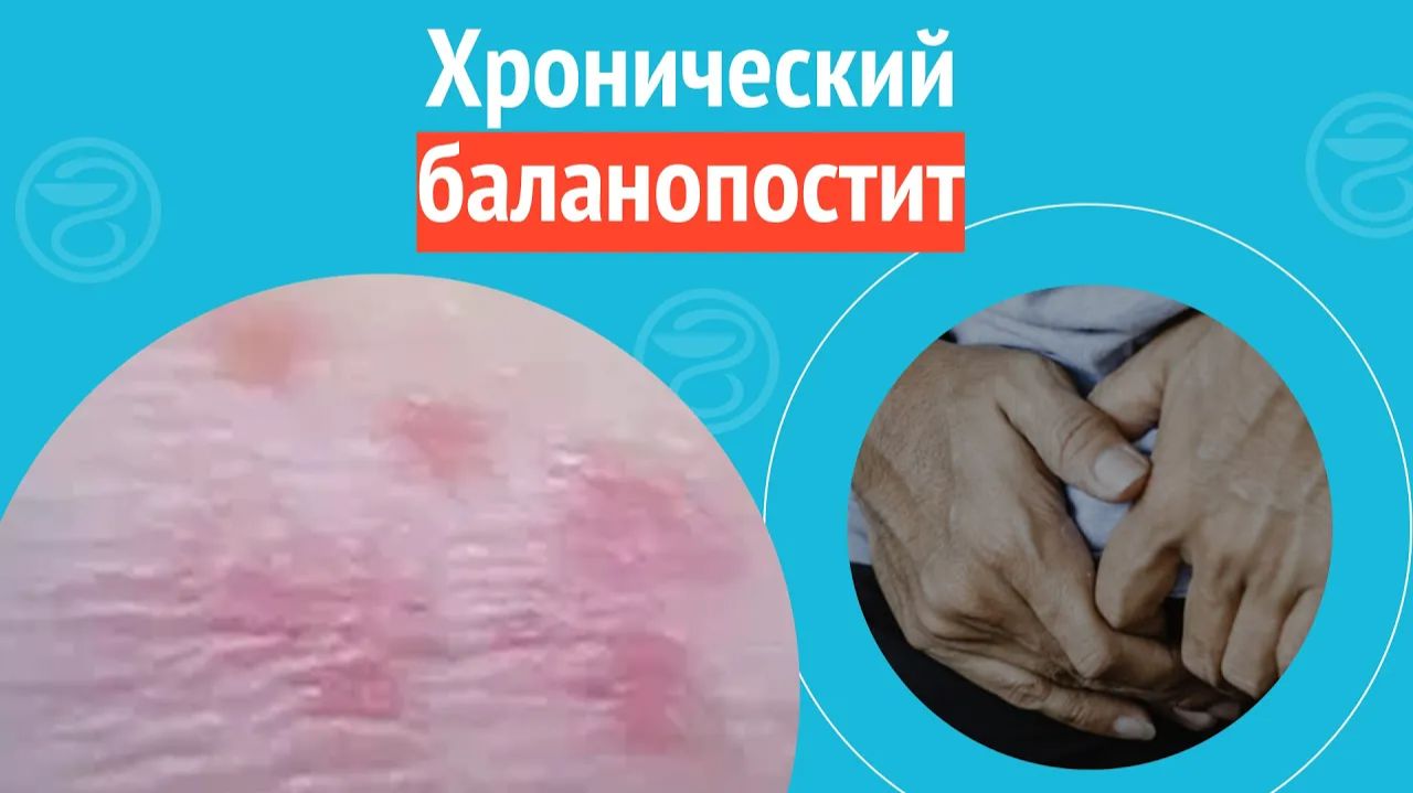 ➡️ Хронический баланопостит. Клинический случай №1313