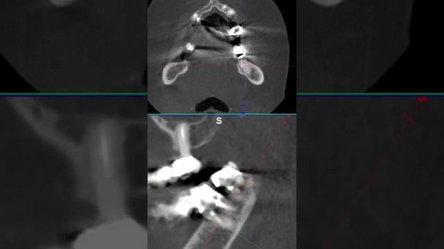 CBCT Diagnostic.Chronic apical  periodontitis of teeth 35-37.SHORT#160