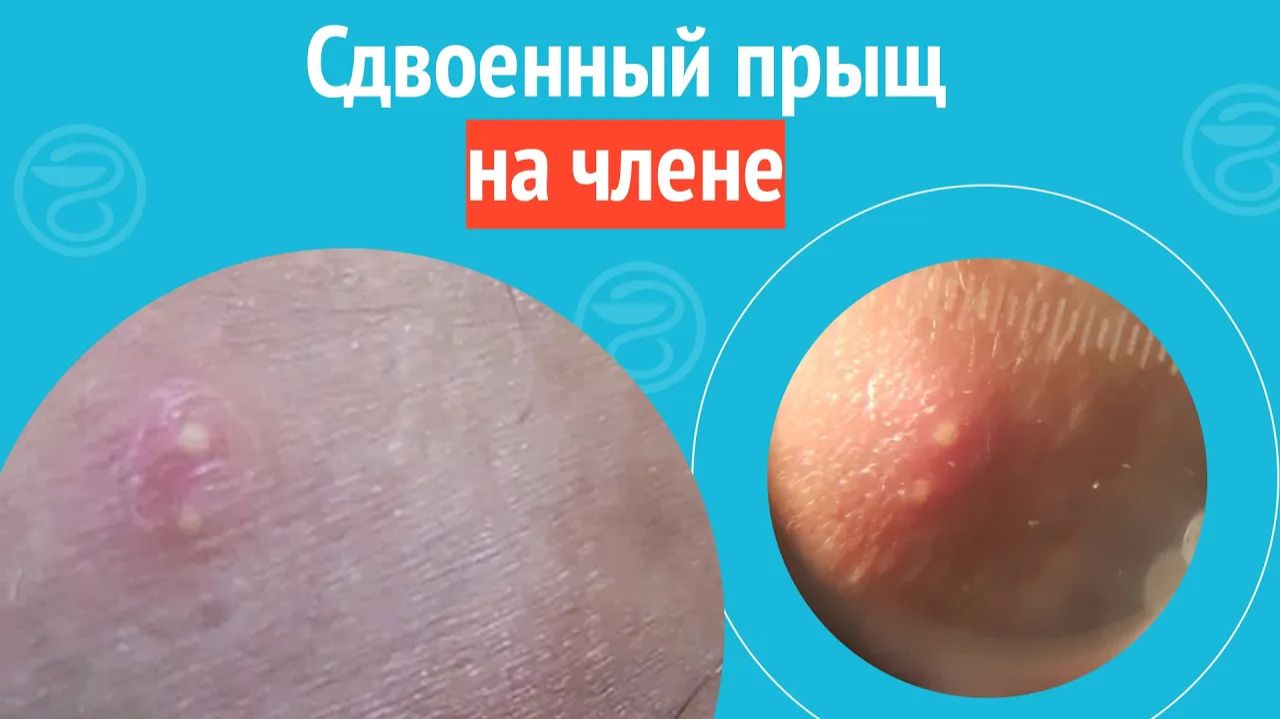 😲 Сдвоенный прыщ на члене. Клинический случай №1318