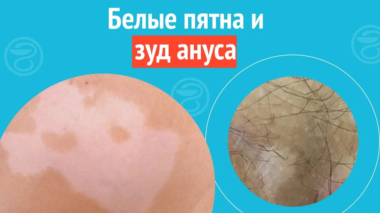 🙄 Белые пятна и зуд ануса. Клинический случай №1317