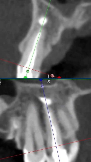 CBCT Diagnostic.Chronic apical  periodontitis of tooth 12. SHORT#119