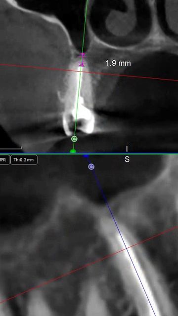 CBCT Diagnostic.Chronic apical  periodontitis of tooth 15. SHORT#124