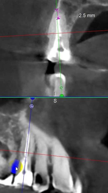 CBCT Diagnostic.Chronic apical  periodontitis of tooth 15. SHORT#129