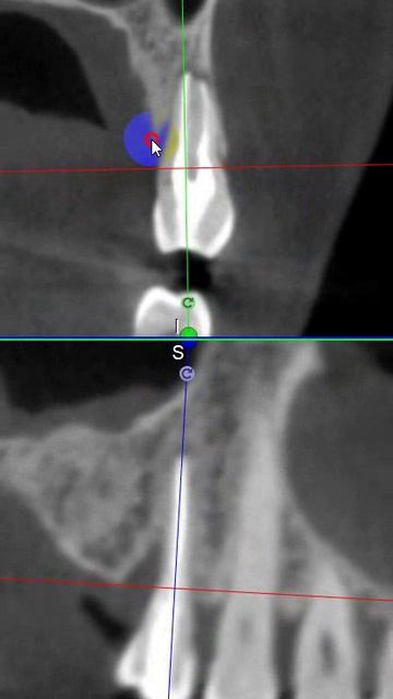 CBCT Diagnostic.Chronic apical  periodontitis of tooth 14. SHORT#117