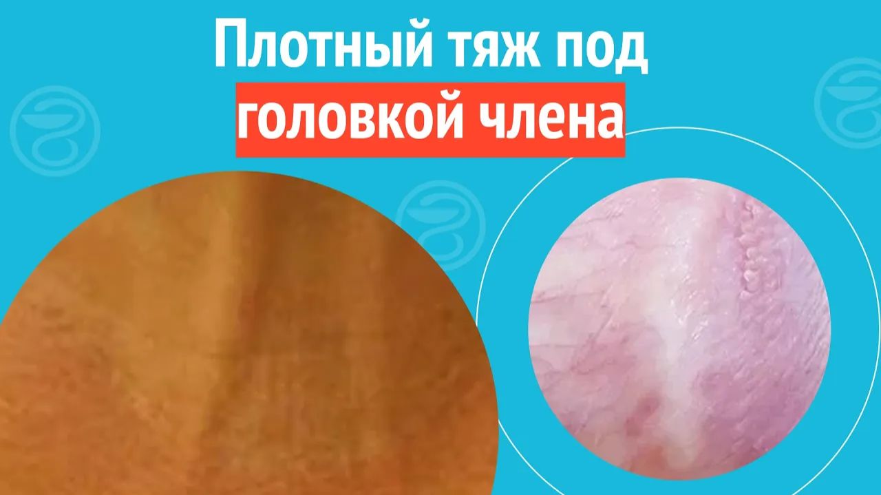 👉 Плотный тяж под головкой члена. Клинический случай №1319