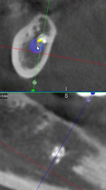 CBCT Diagnostic.Residues of the filler after tooth extraction 47. SHORT#67