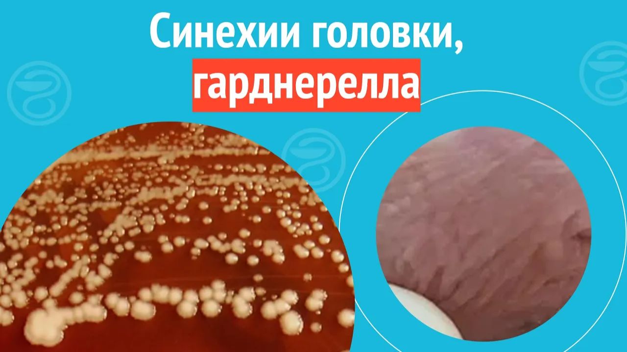 😮 Синехии головки, гарднерелла, уреаплазма и кандида. Клинический случай №1312