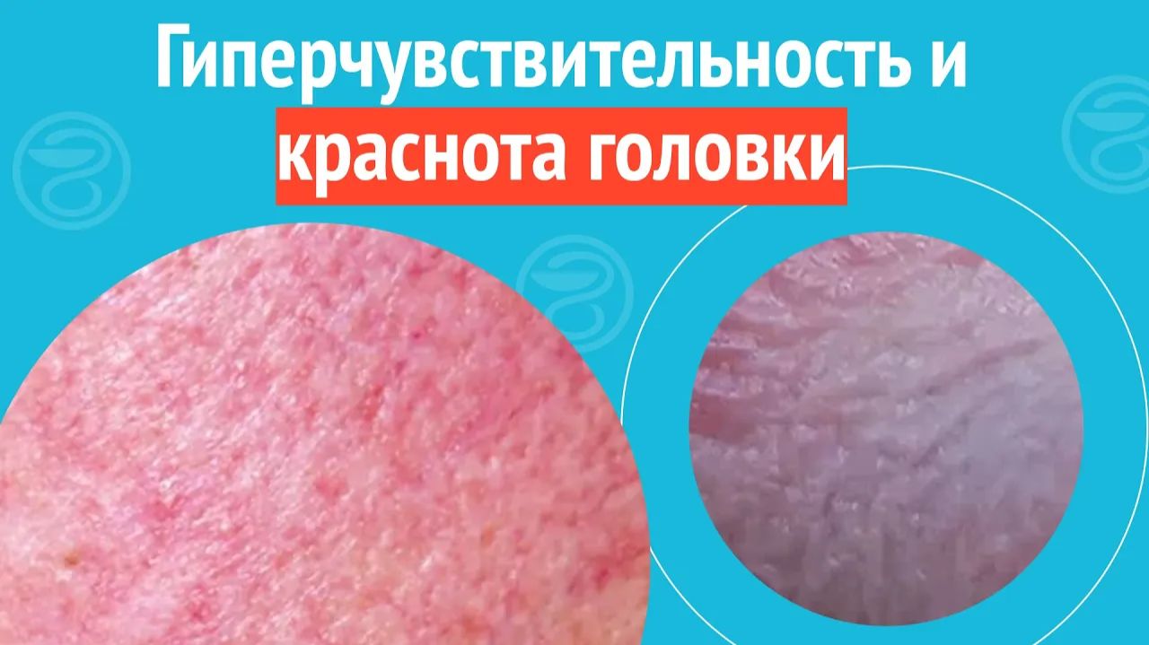 😡 Гиперчувствительность и краснота головки. Клинический случай №1320