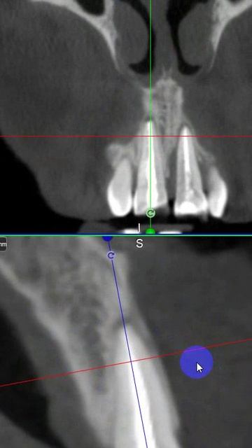 CBCT Diagnostic.Chronic apical  periodontitis of tooth 11. SHORT#115