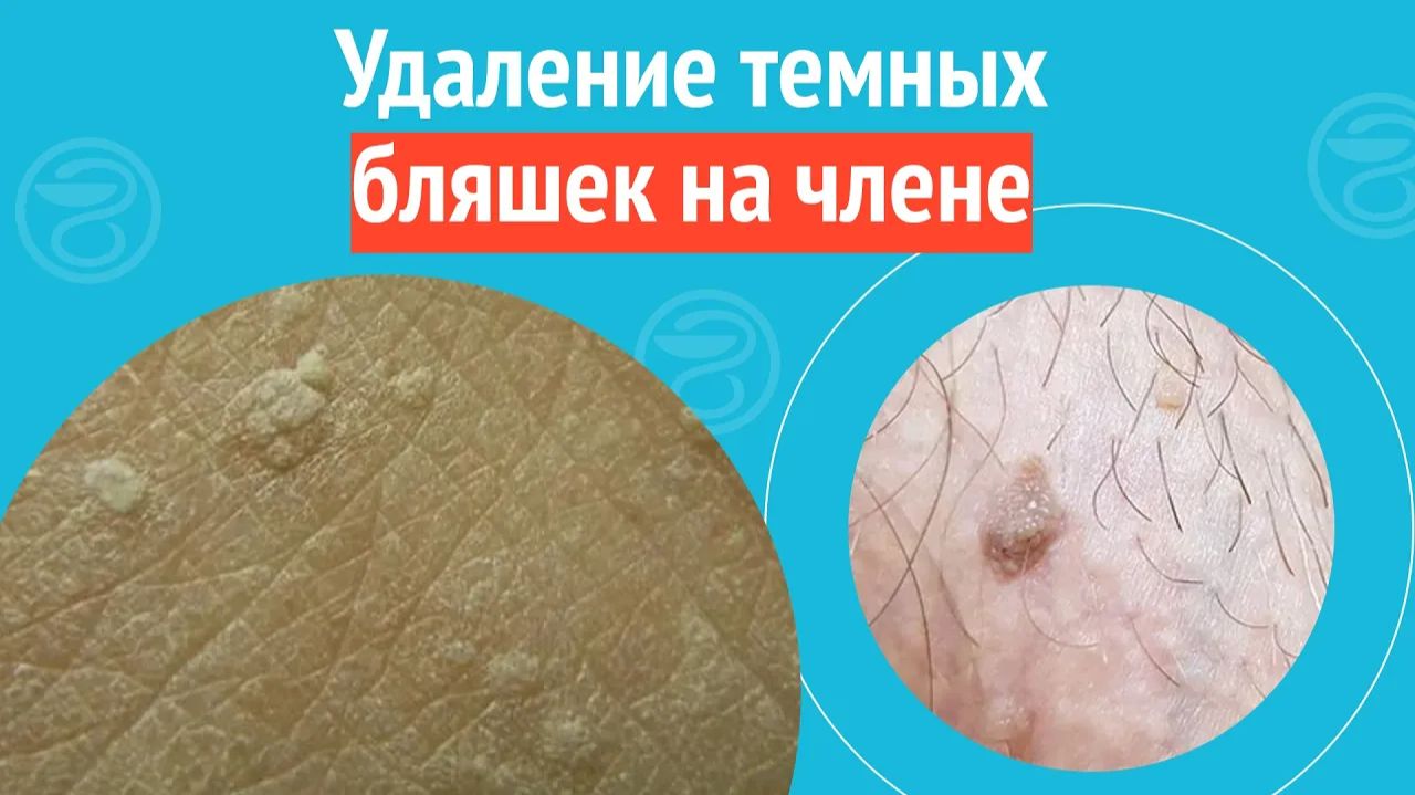 🤨 Удаление темных бляшек на члене. Клинический случай №1316