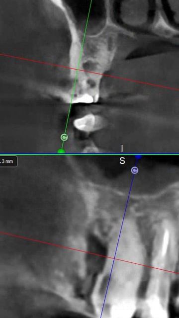 CBCT Diagnostic.Chronic apical  periodontitis of tooth 16. SHORT#128