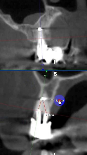 CBCT Diagnostic.Chronic apical  periodontitis of tooth 14.SHORT# 156