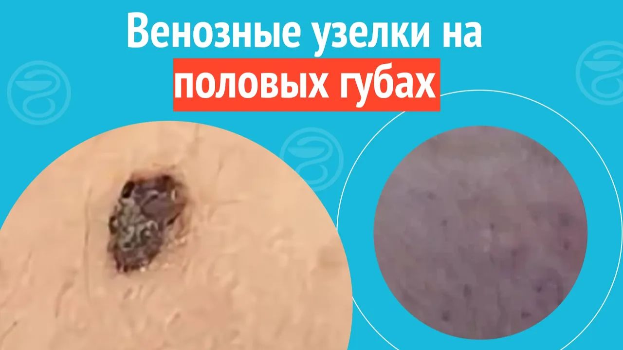 👩 Венозные узелки на половых губах. Клинический случай №1323