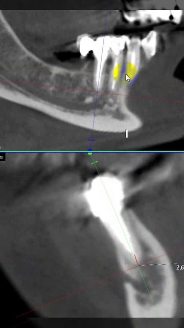 CBCT Diagnostic.Chronic apical  periodontitis of teeth 44,45.SHORT#161
