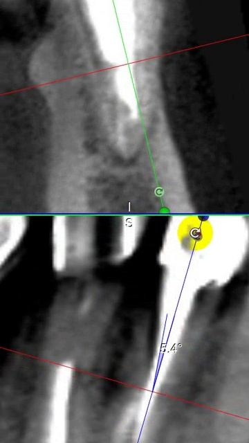CBCT Diagnostic.Chronic apical  periodontitis of teeth 34,35. SHORT#133