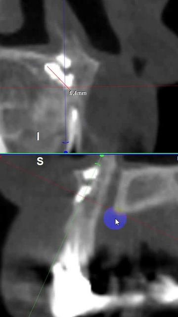 CBCT Diagnostic.Chronic apical  periodontitis of tooth 11.SHORT#157