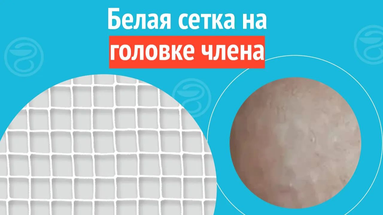 👉 Белая сетка на головке члена. Клинический случай №1315