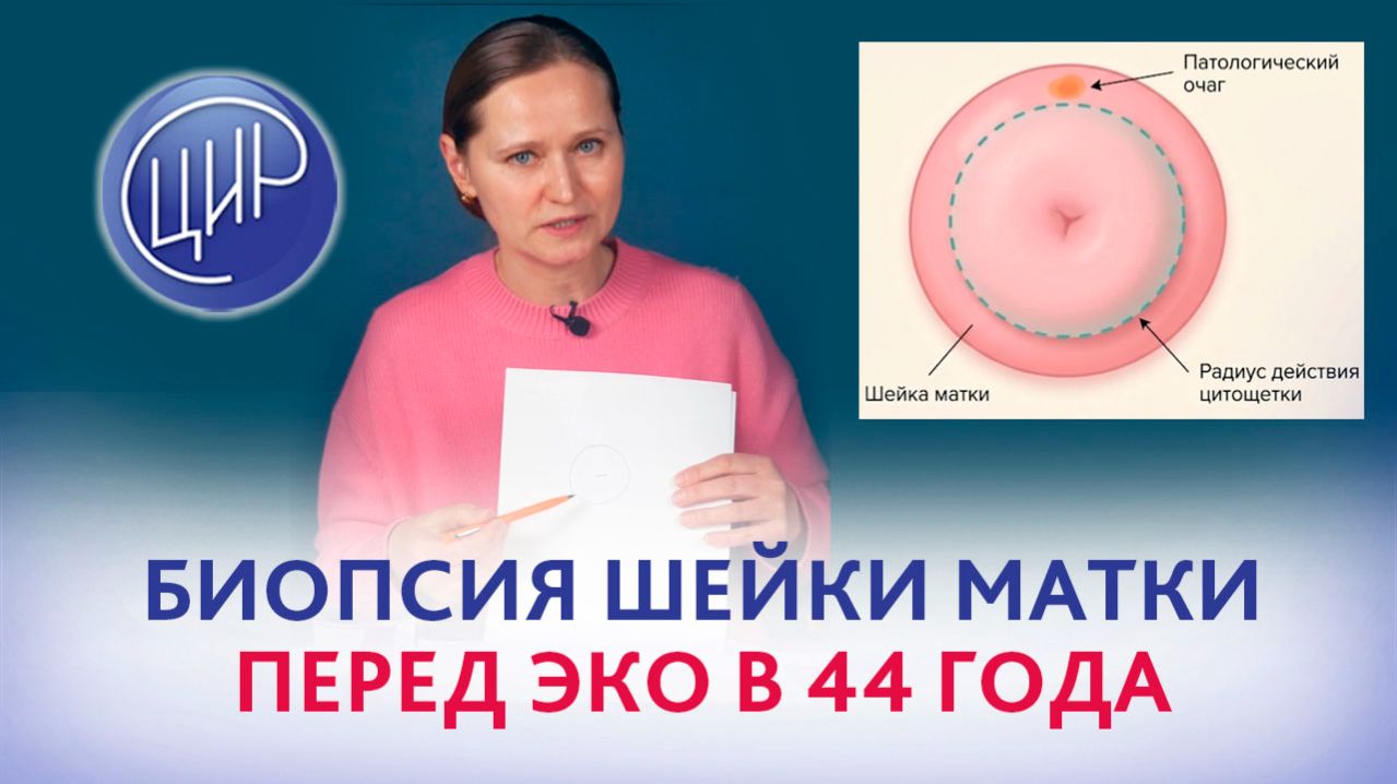 Биопсия шейки матки. Нужно ли делать биопсию перед ЭКО?