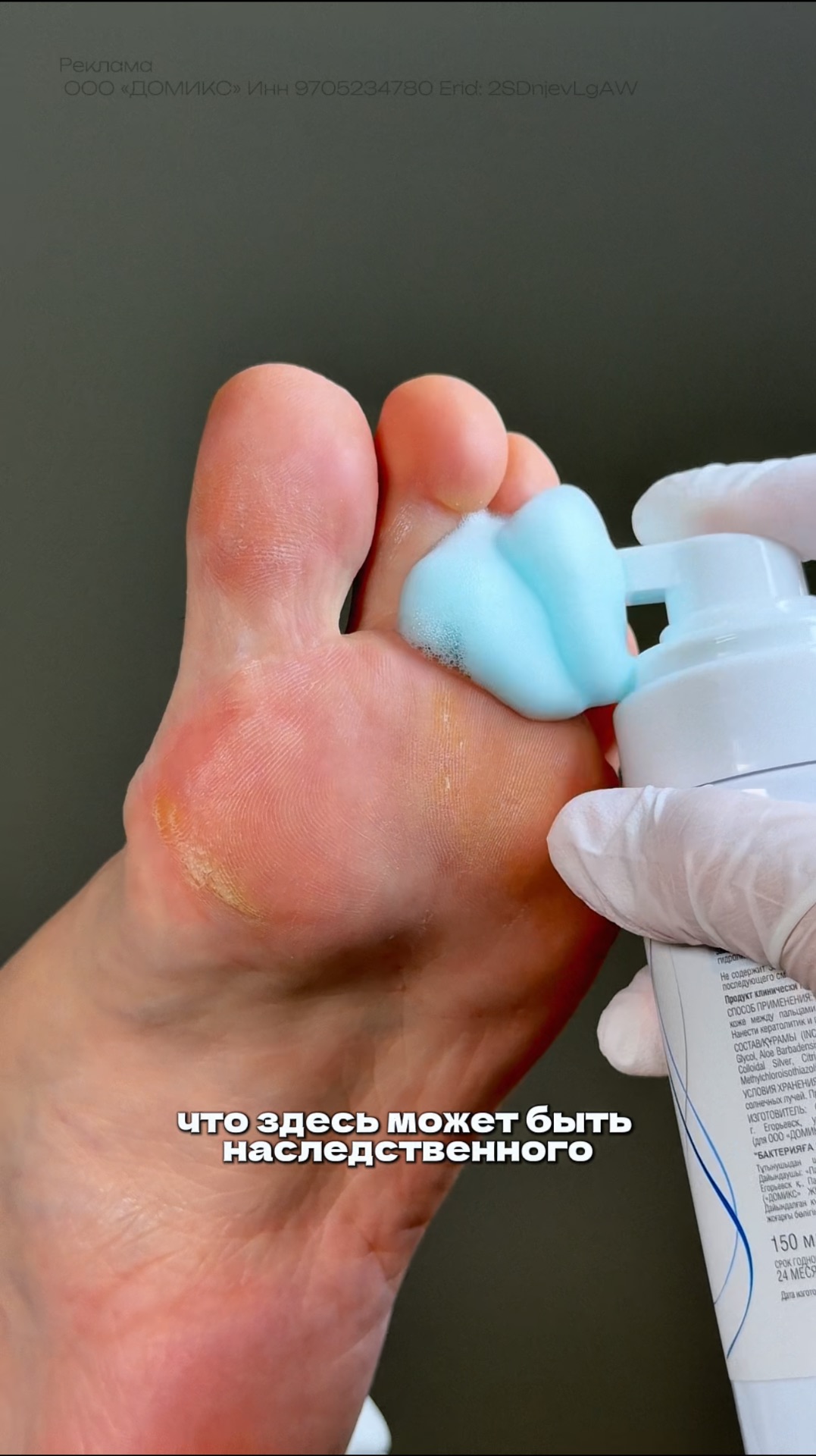 Мозоли и натоптыши это наследственная история?🧐