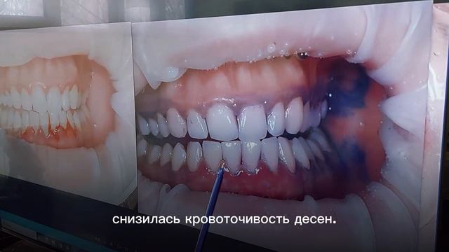 Клинический случай: лечение воспаления дёсен #гингивит #гигиенаполостирта #десны #лечение #рутуб