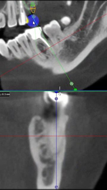 CBCT Diagnostic.Chronic apical  periodontitis of tooth 36. SHORT#118
