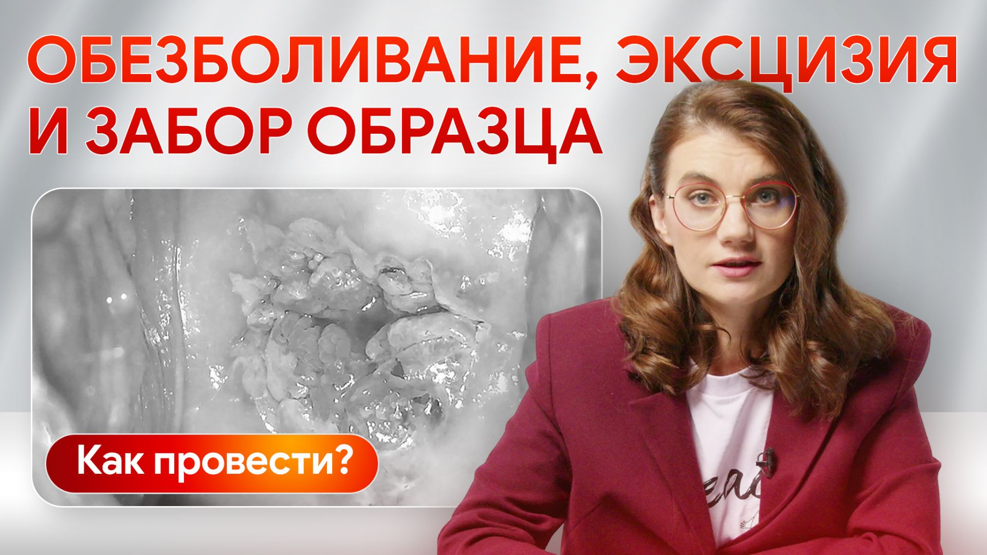 Кольпоскопия: как проводить обезболивание, эксцизию и забор эндоцервикального образца?