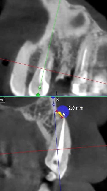 CBCT Diagnostic.Chronic apical  periodontitis of tooth 23.SHORT#144