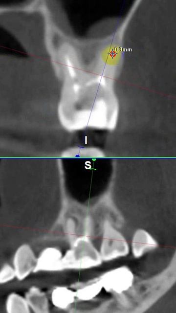 CBCT Diagnostic.Chronic apical  periodontitis of tooth 26.SHORT#151