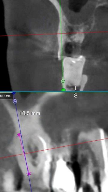 CBCT Diagnostic.Chronic apical  periodontitis of tooth 16.SHORT#145,