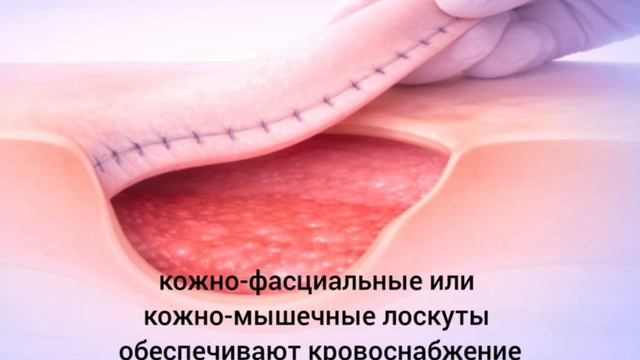 8. Лечение пролежней 4 степени