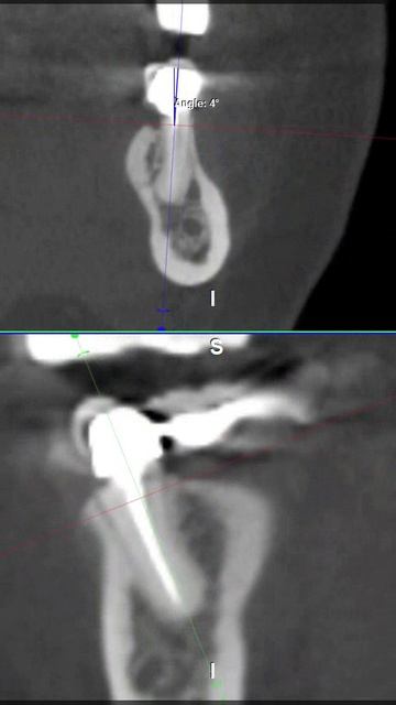 CBCT Diagnostic.Chronic apical  periodontitis of tooth 35.SHORT#152