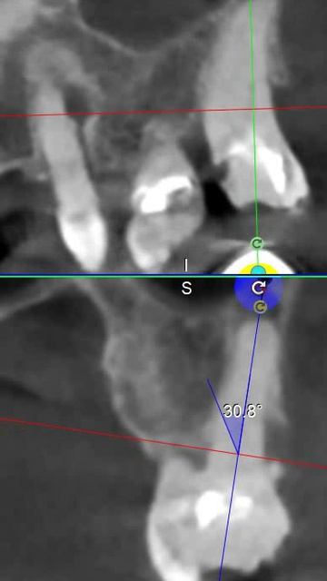 CBCT Diagnostic.Chronic apical  periodontitis of tooth 27. SHORT#127