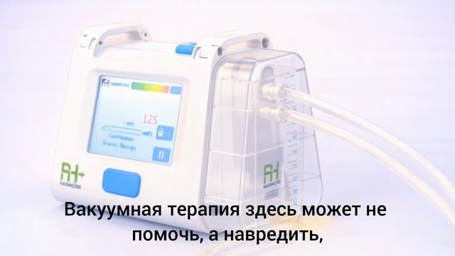 9. Вакуумная терапия пролежней