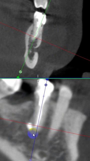 CBCT Diagnostic.Chronic apical  periodontitis of tooth 35. SHORT#120