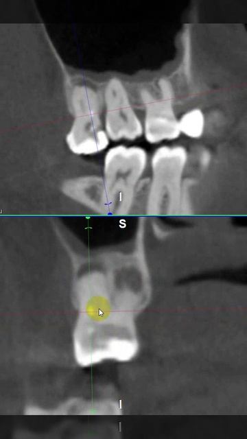 CBCT Diagnostic.Chronic apical  periodontitis of tooth 18.SHORT#155