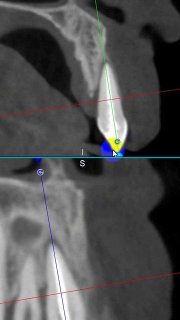 CBCT Diagnostic.Chronic apical  periodontitis of tooth 21. SHORT#116