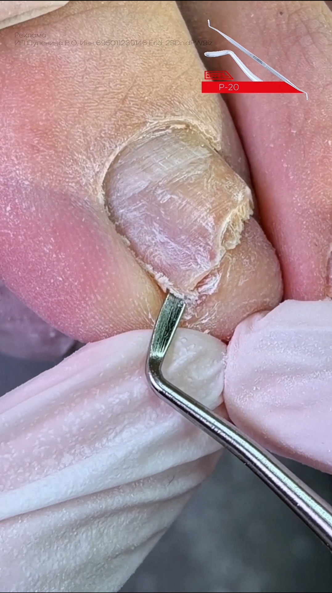 обработка онихолизиса ❤️