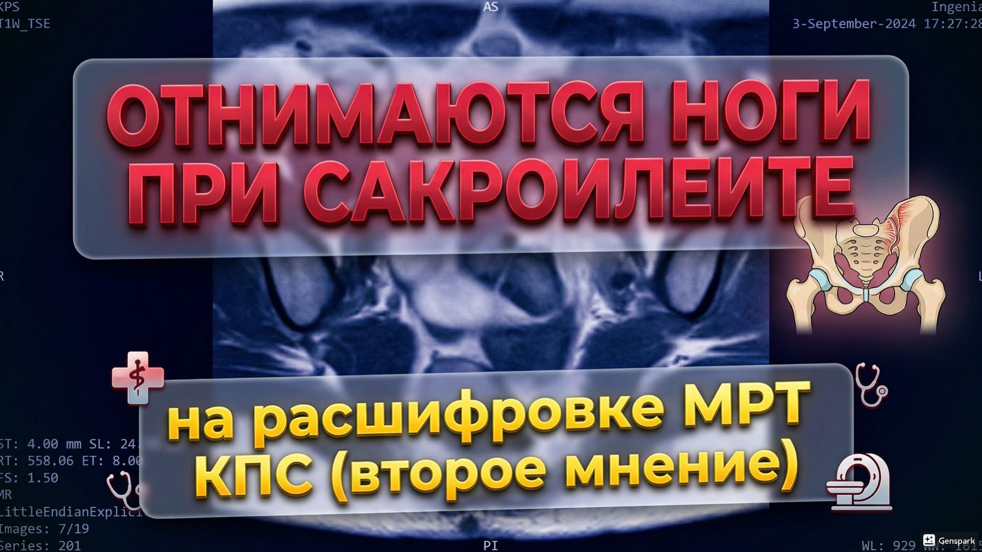 СЛАБОСТЬ В НОГАХ при двустороннем САКРОИЛЕИТЕ на РАСШИФРОВКЕ МРТ крестцово-подвздошных сочленений