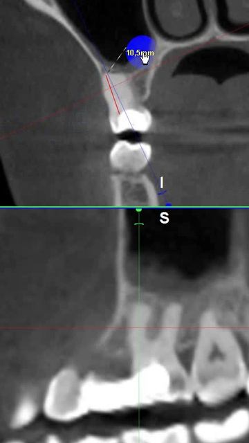 CBCT Diagnostic.Chronic apical  periodontitis of tooth 16.SHORT#150