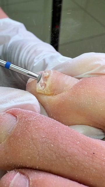 ЗАЧИСТКА онихолизиса