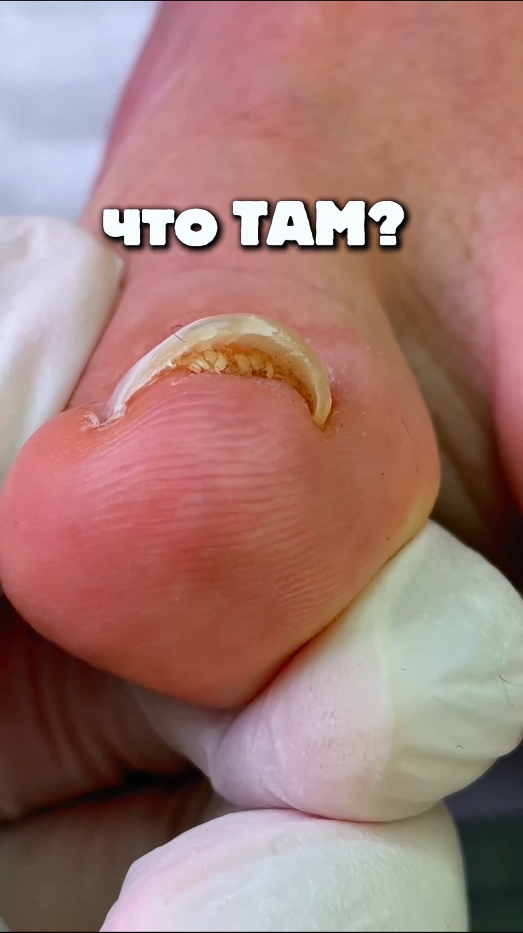 онихолизис больших масштабов 😳