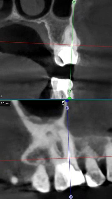 CBCT Diagnostic.Chronic apical  periodontitis of tooth 26. SHORT#123