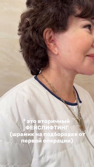 ВТОРИЧНЫЙ ФЕЙСЛИФТИНГ, 5 НЕДЕЛЬ 🤍