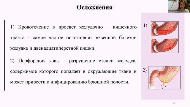 Профилактика обострений язвенной болезни желудка и двенадцатиперстной кишки"