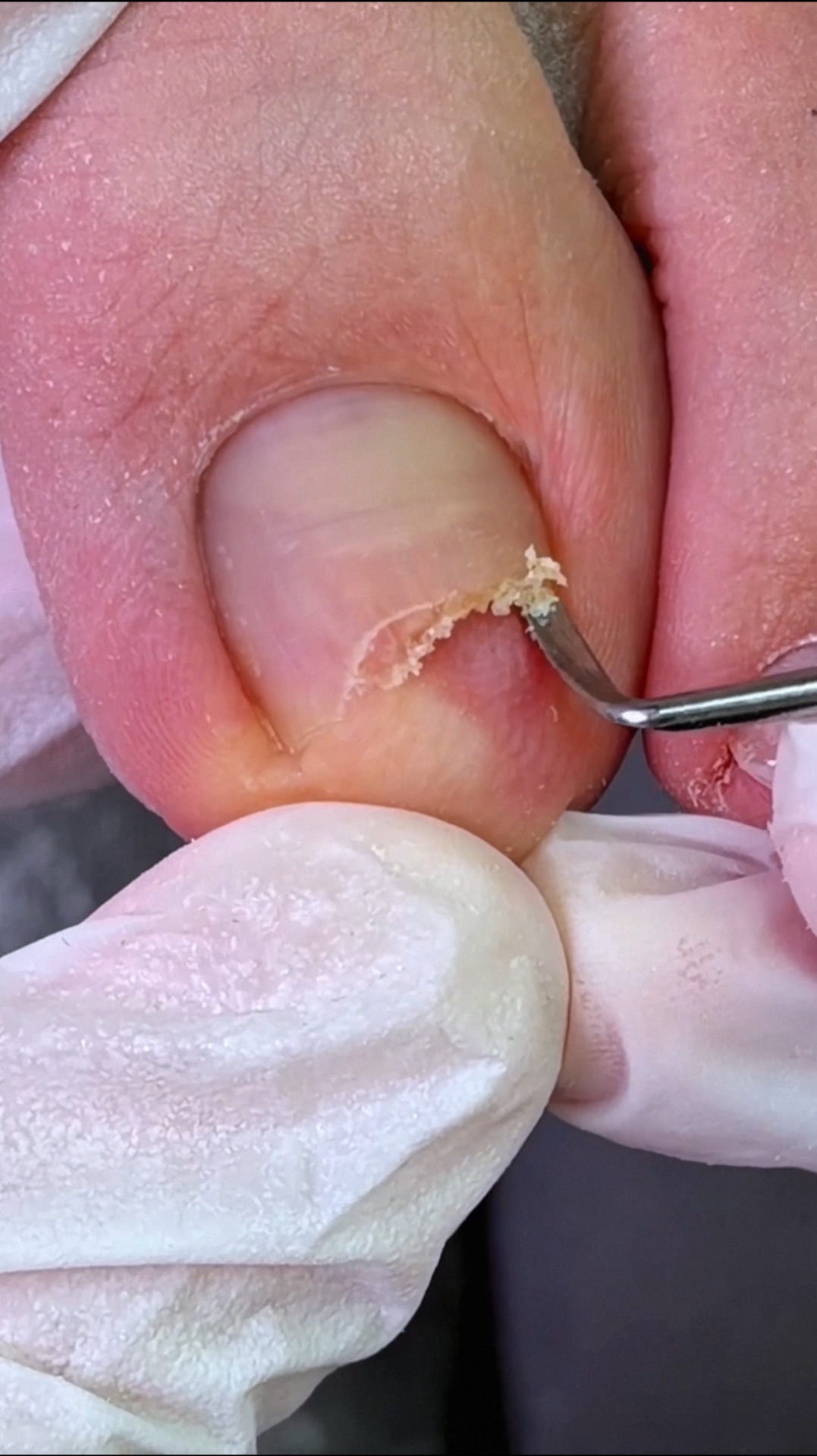 так проще зачищать онихолизис