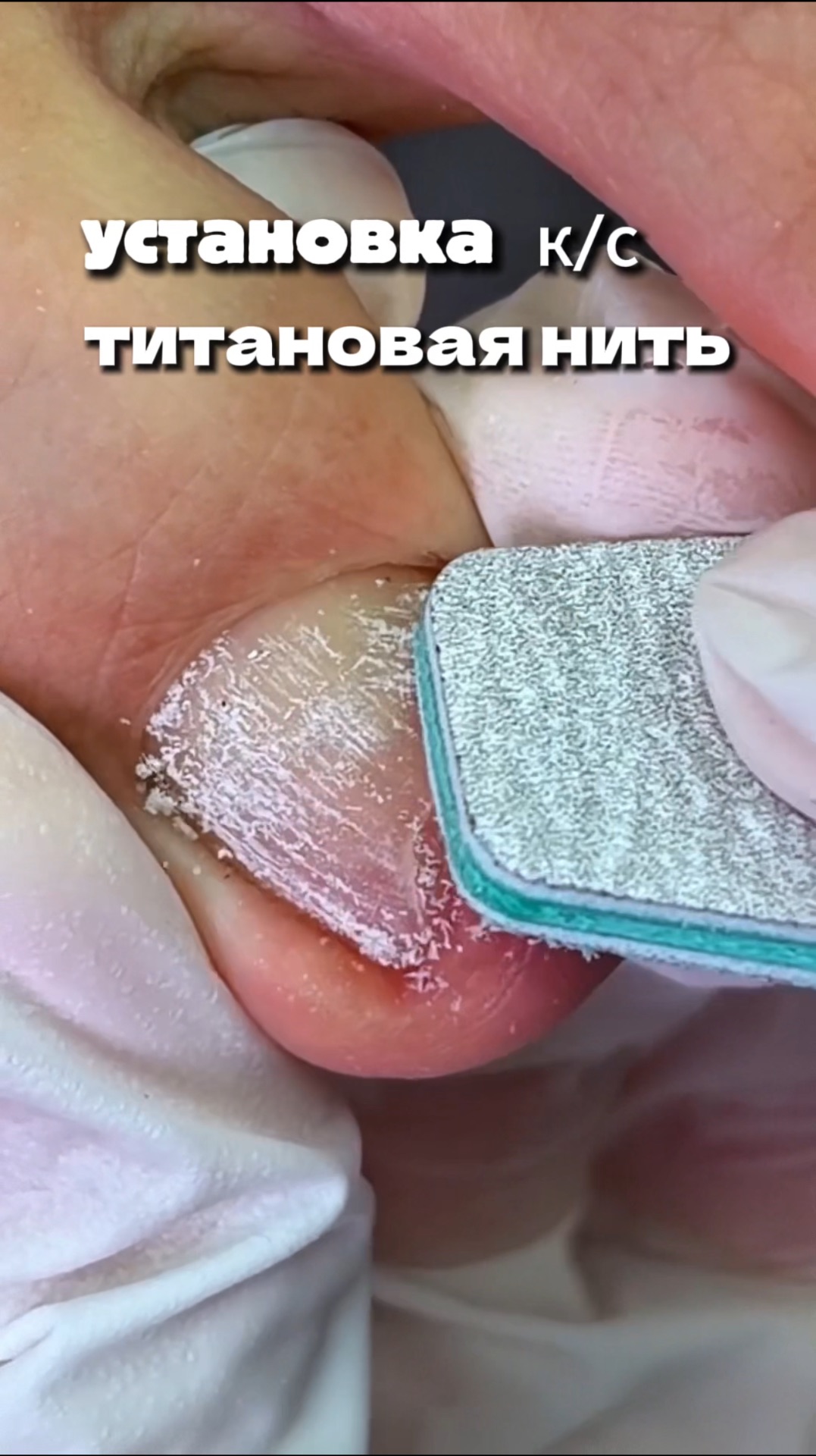 установка титановой нити 💪🏼