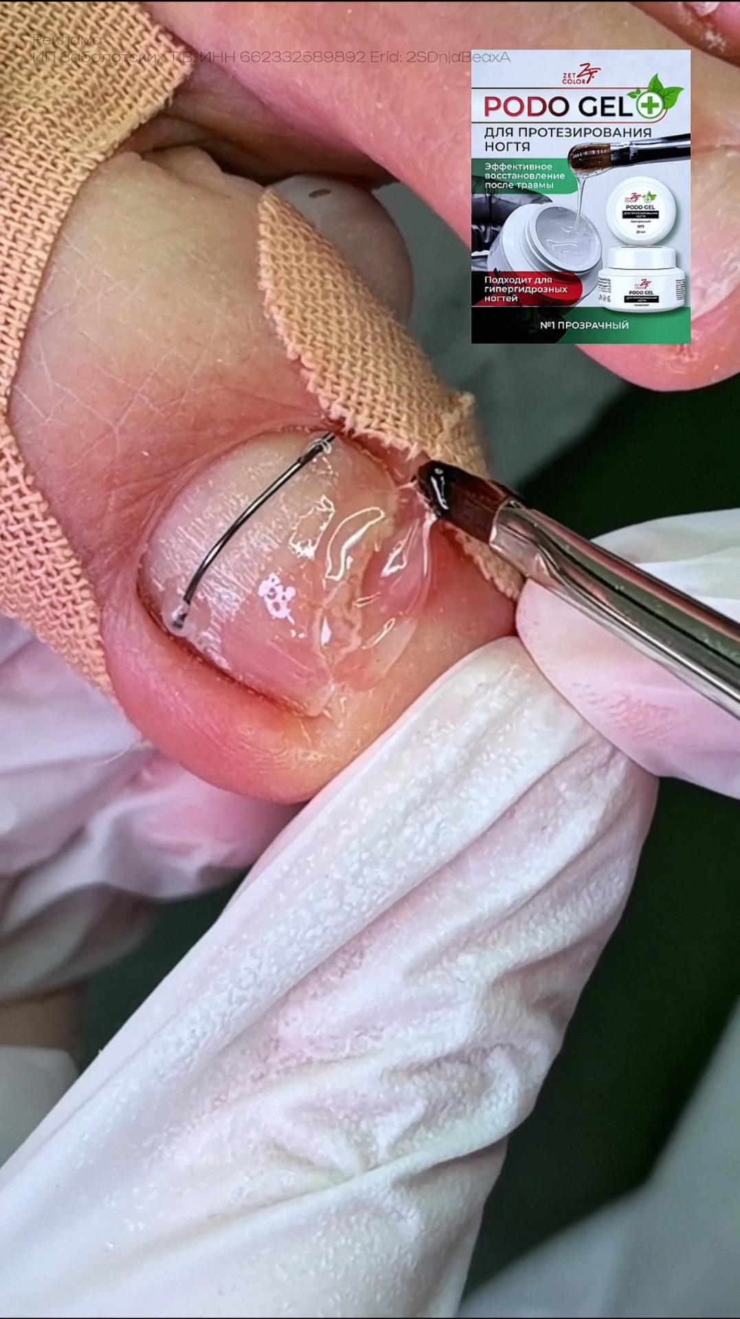 протезирования ногтя после зачистки ❤️